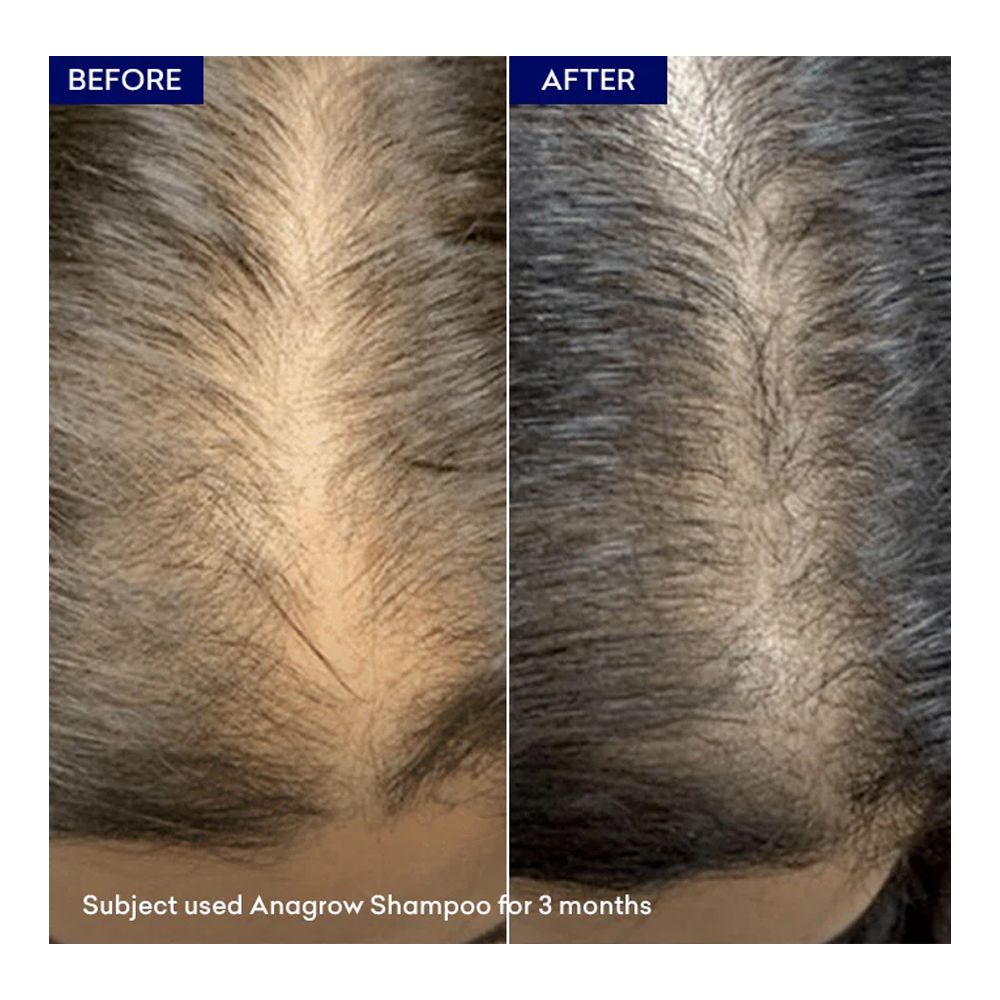 Buy Jen Pharm Anagrow Shampoo, For All Hair Types, 100ml Online at Best ...