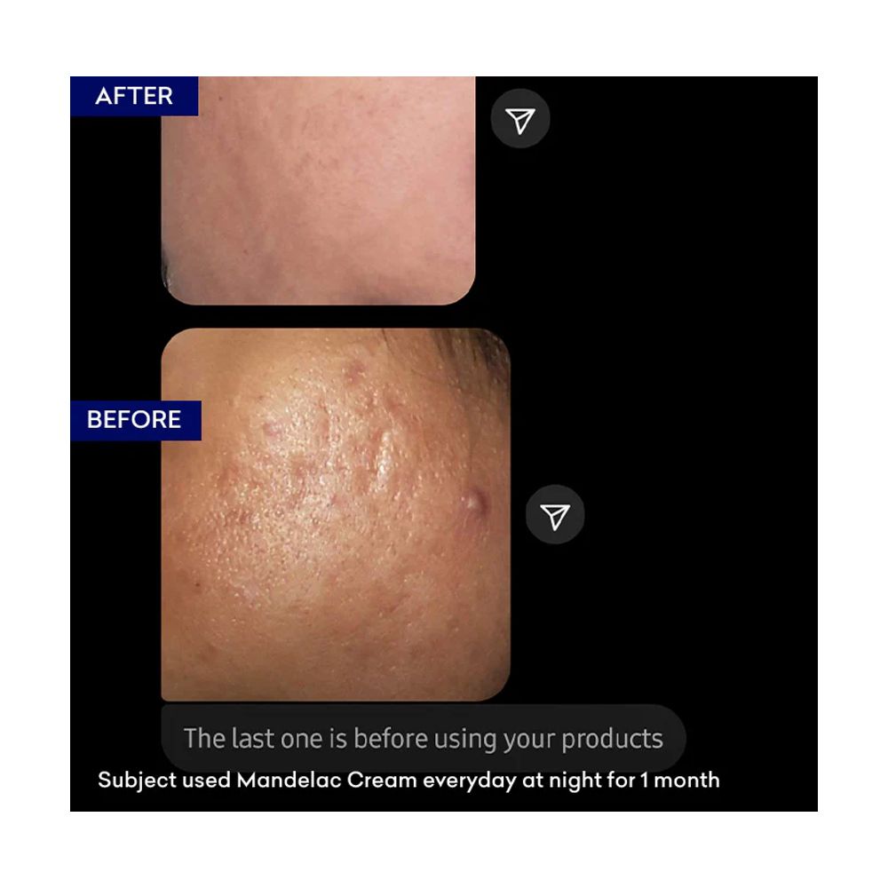 Order Jenpharm 10% Mandelac Exfoliating Night Cream, Reduces Acne ...